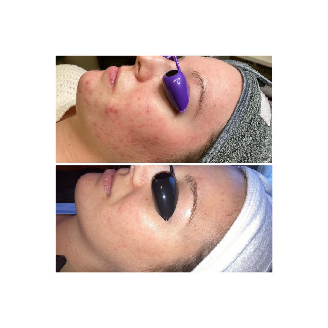 Face Reality Acne Program | Skin Positive by Liz