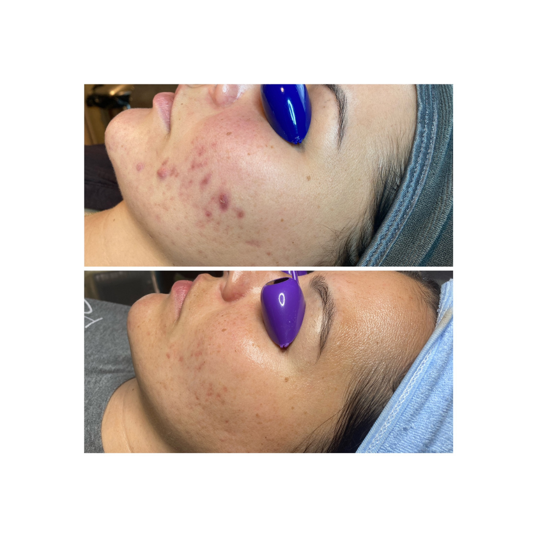Face Reality Acne Program | Skin Positive by Liz